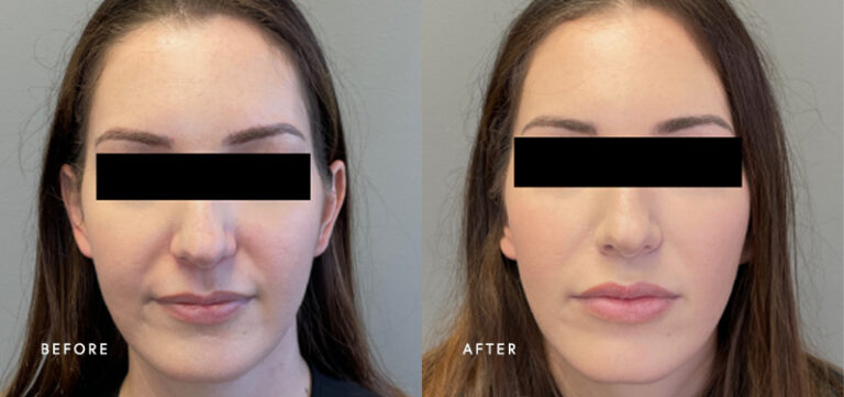 RHA Dermal Fillers New Orleans - New Orleans Aesthetics