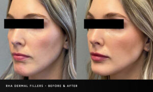 RHA Dermal Fillers New Orleans - New Orleans Aesthetics - New Orleans ...